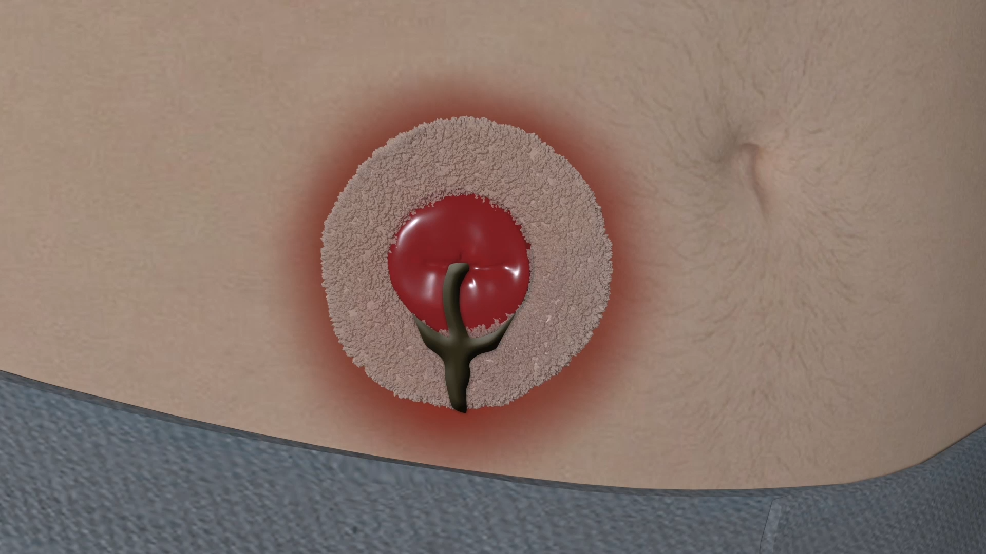 FLOWASSIST - Ostoform